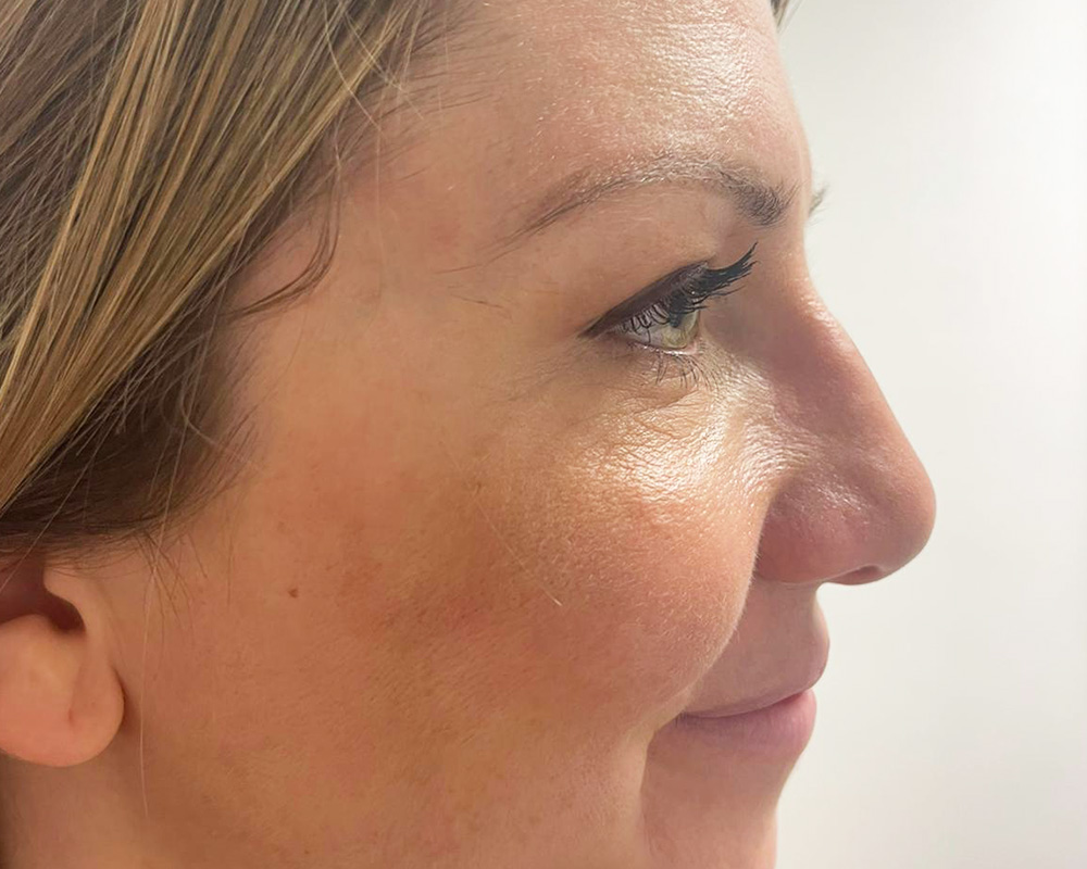 Botulinum Toxin (Anti-wrinkle) Injections – Dr. Claire Aesthetics