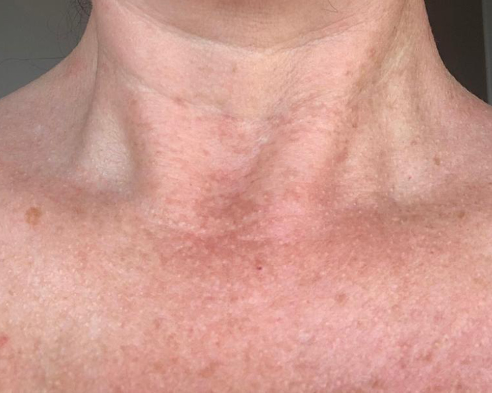 Profhilo - Dr. Claire Aesthetics