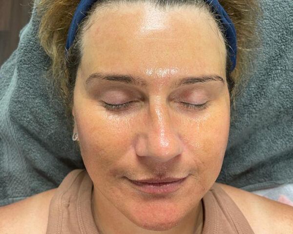 ZO Stimulator Peel - Dr. Claire Aesthetics